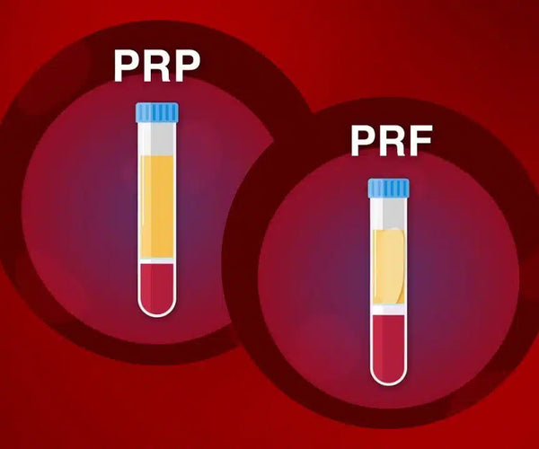 PRP vs PRF: Which Treatment Is Better for Hair Loss? – Charles Medical